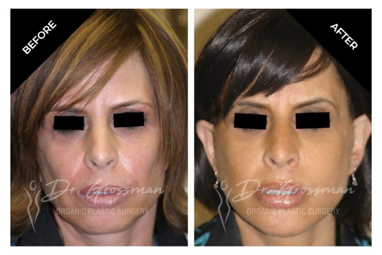 Fat Transfer And Facial Rejuvenation Before & After Images