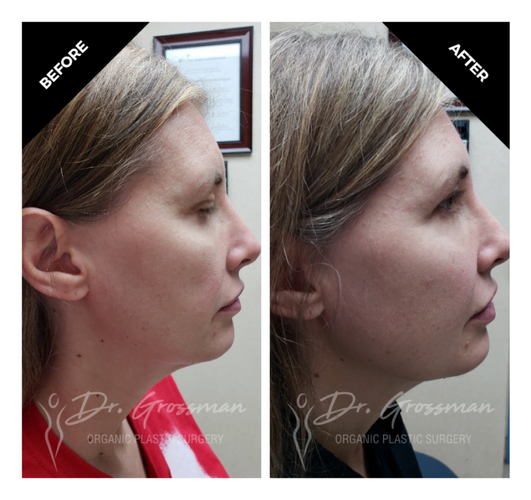 Fat Transfer And Facial Rejuvenation Before & After Images